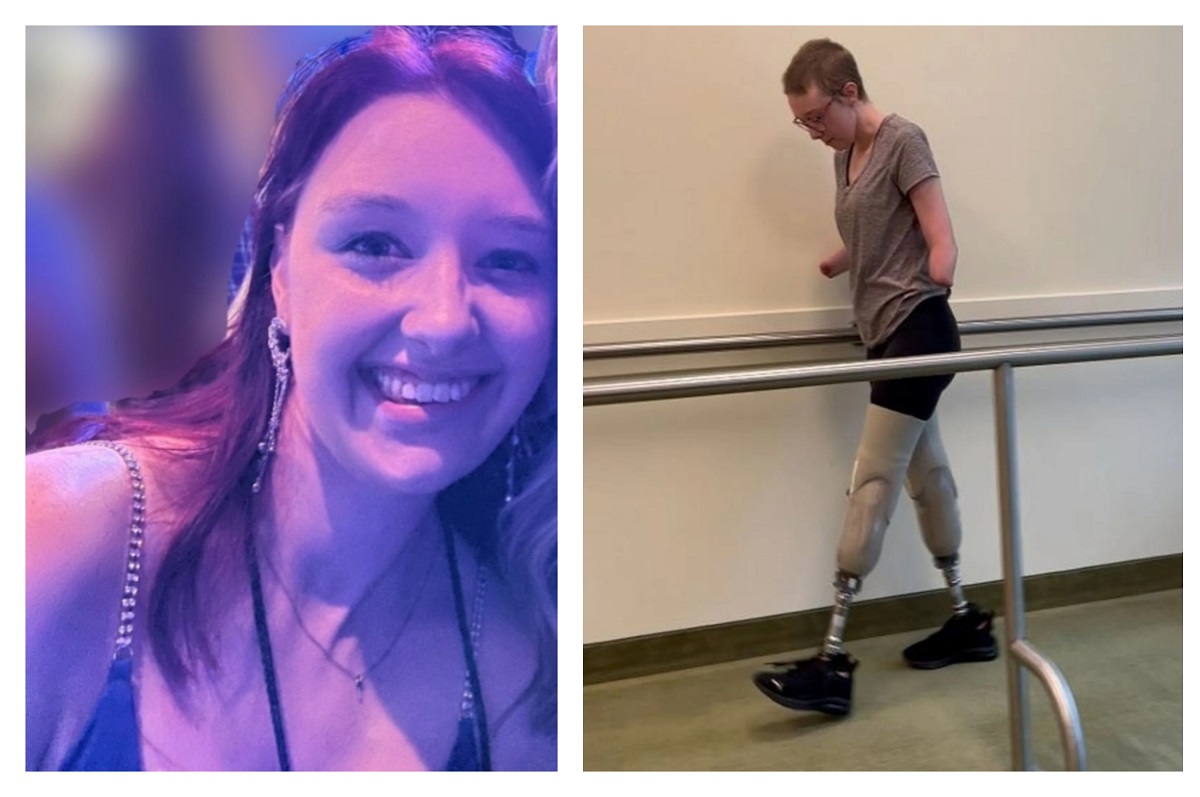 Jovem contrai doença em show e tem as mãos e pernas amputadas